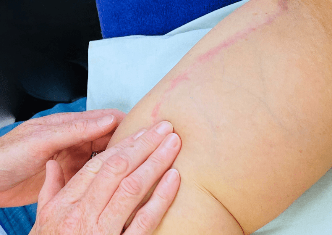 Scar Therapy Practitioner Course | Restore Therapy